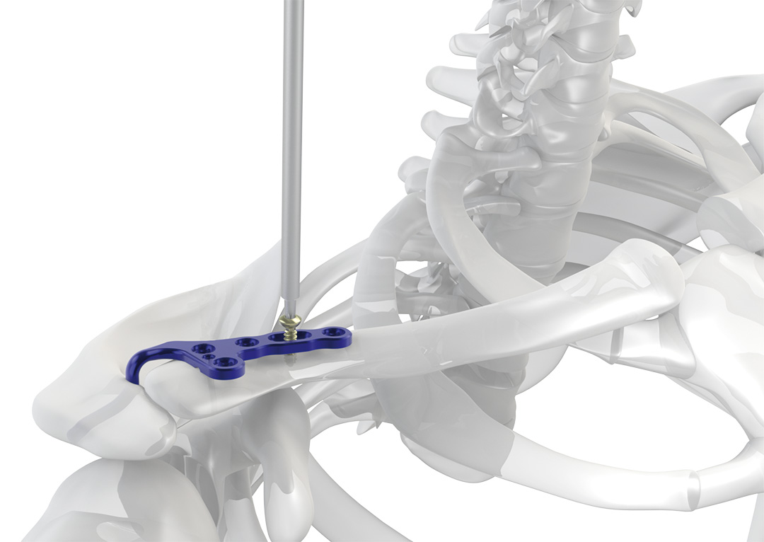 ACG-Hakenplatte 3.5 vws - perfekt im Einsatz » Implantate aus Koenigsee