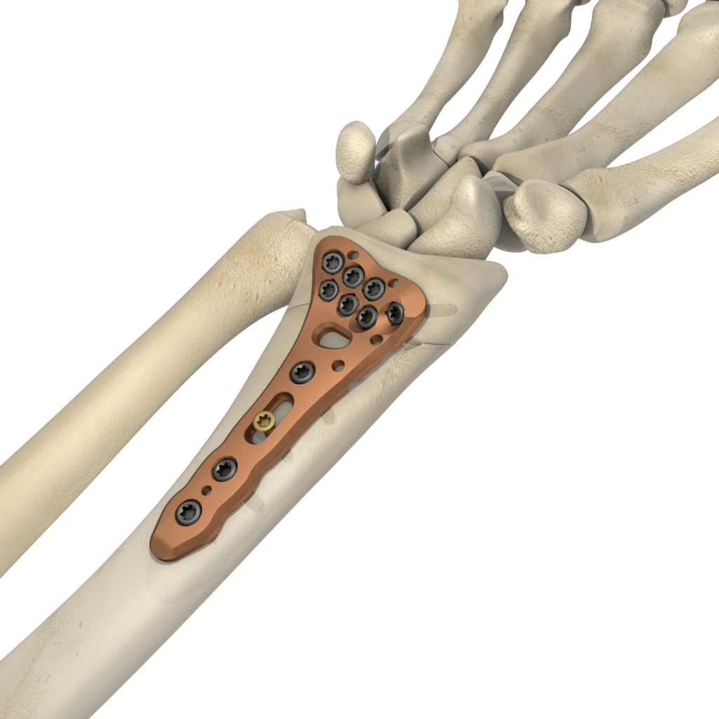 Radius Story » Implantate aus Koenigsee